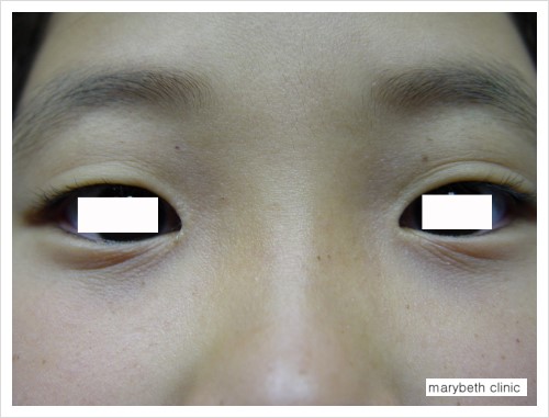 알레르기샤이너(Allergic shiner) 1예 : 네이버 블로그