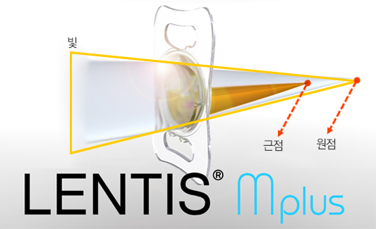 다초점렌즈 노안교정 - 1. 렌티스(Lentis) 렌즈 : 네이버 블로그