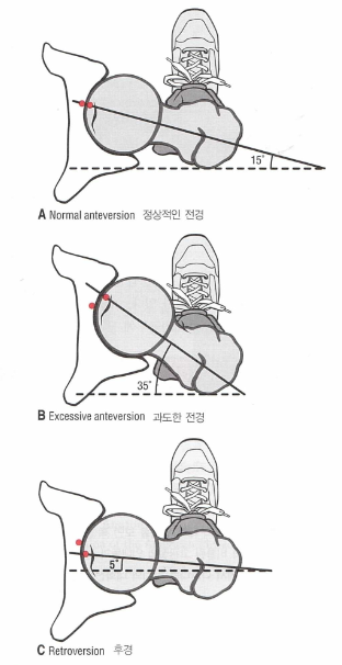 Hip anteversion & retroversion : 네이버 블로그