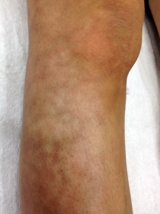 열성홍반 (Erythema ab igne) : 네이버 블로그