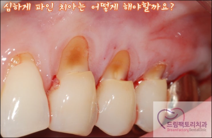 남양주치과구리치과 치아 옆 부분이 파인치아치경부마모증를 더 파이지 않게 레진으로 수복하기 Of 드림팩토리치과 네이버 블로그