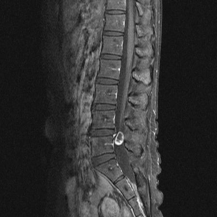 Intradural extramedullary cystic mass : 네이버 블로그