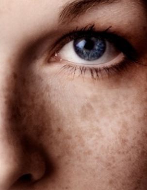 피부성형] ABNOM(오타양 반점) : 네이버 블로그