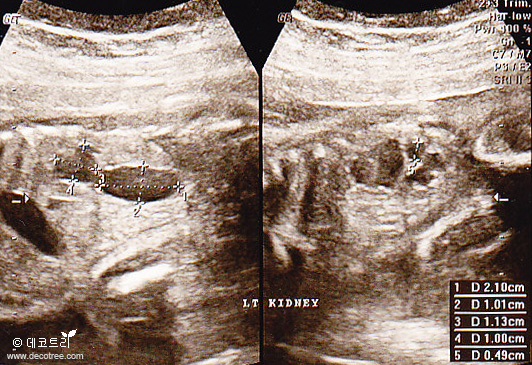 다낭성 신 이형성증(multicystic dysplastic kidney, MCDK) : 네이버 블로그