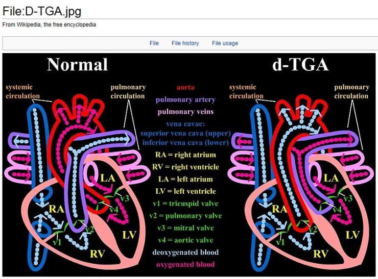 D-TGA / CC-TGA(Congenitally corrected transposition of the great ...