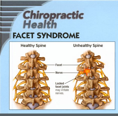Facet Syndrome - A Radiographic Enigma : 네이버 블로그