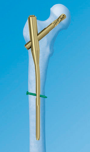 Proximal femur fracture - PFNA vs. CHN : 네이버 블로그