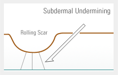 서브시전(subcision)에 대해서 : 네이버 블로그