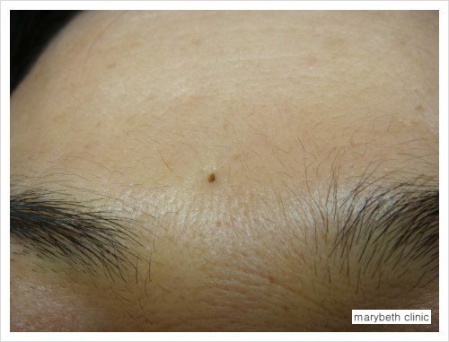 Dilated pore of Winer(와이너 확장구멍) 임상 소견 : 네이버 블로그