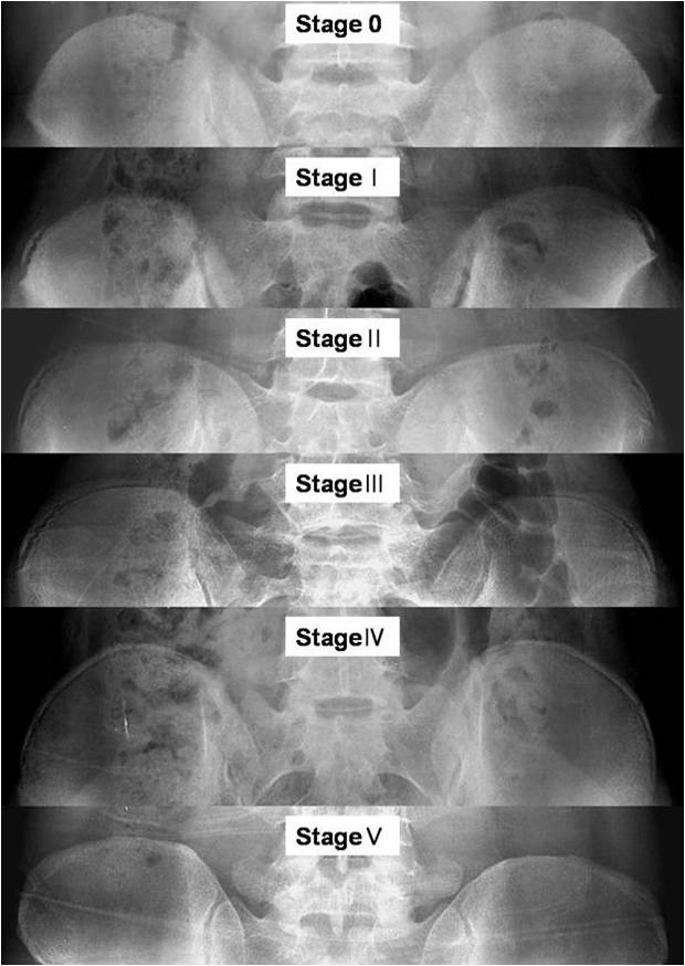 [제너럴 피트니스 척추측만증 이야기#2]왜 조기에 측만증운동을 시작해야 할까요? - 상편 : 네이버 블로그