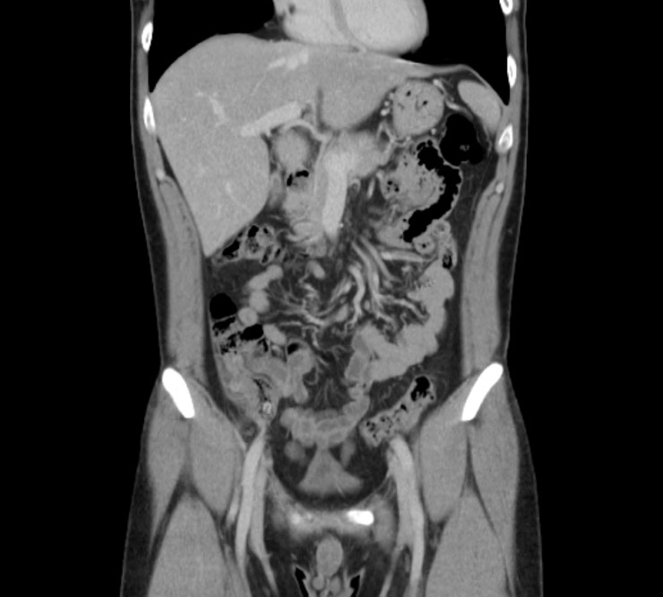 Appendicitis vs Right sided colonic diverticulitis/elongated sigmoid ...