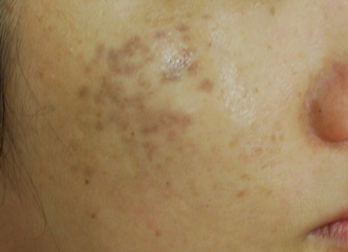 목포 오타반점][목포 오타양 반점][목포 오타양모반][목포 피부과][목포 ABNOM][목포 어브놈][목포 어브넘] 후천성 양측성 ...