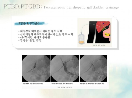 PTBD와 PTGBD 차이 (경피적 담관배액술) : 네이버 블로그