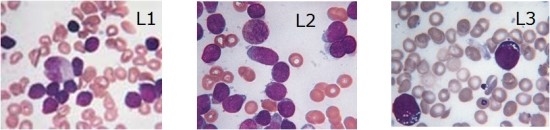 혈액종양 - AML, ALL. MDS : PBS소견 : 네이버 블로그