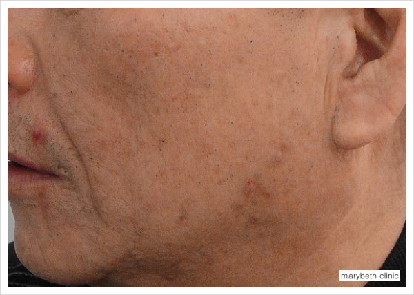 콜타르 피치 여드름(Coal tar/pitch acne ) : 네이버 블로그