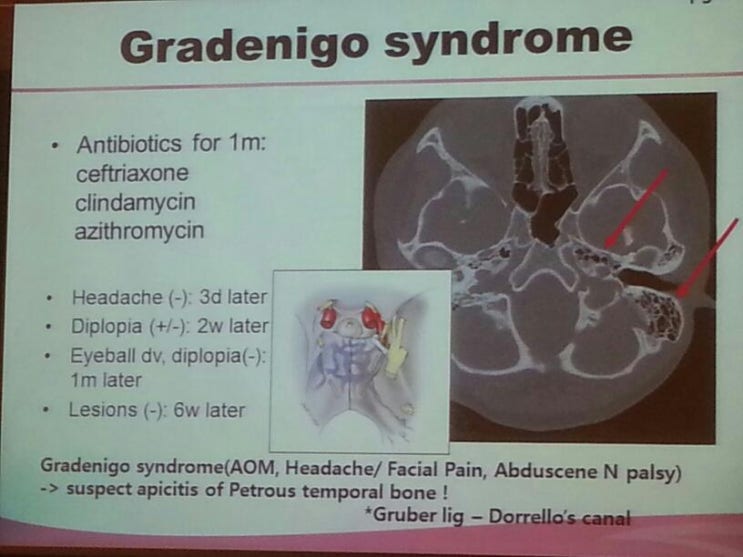 Gradenigo's syndrome: 중이염 후 사시가 되는 질병인데 항생제만 써도 좋아집니다 : 네이버 블로그