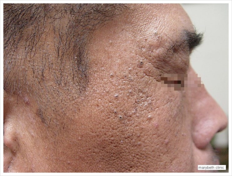 노인성 면포(Senile Comedones) - 여드름클리닉 : 네이버 블로그