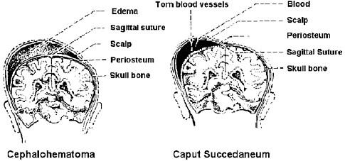 산류caput succedaneum & 두혈종cephalohematoma : 네이버 블로그