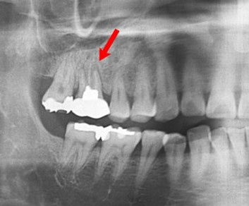 신경치료 후 통증과 재신경치료(re-endo) : 네이버 블로그