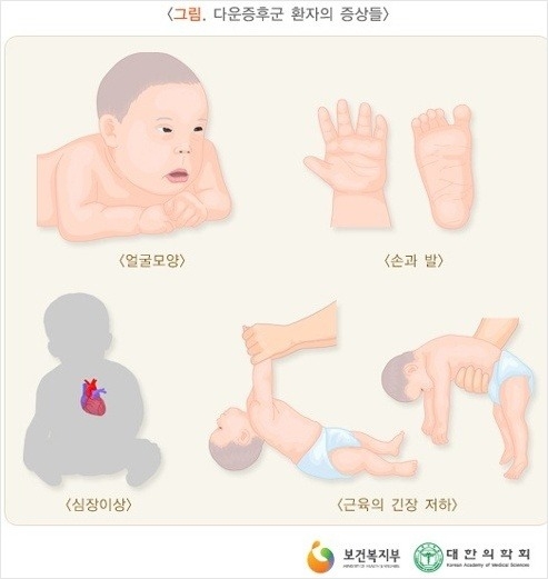 지적장애아교육 지적장애의 원인 및 예방 네이버 블로그