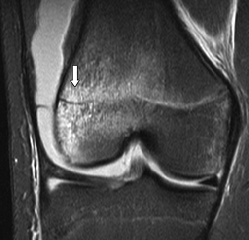 23세 여자, Transient lateral patellar dislocation : 네이버 블로그