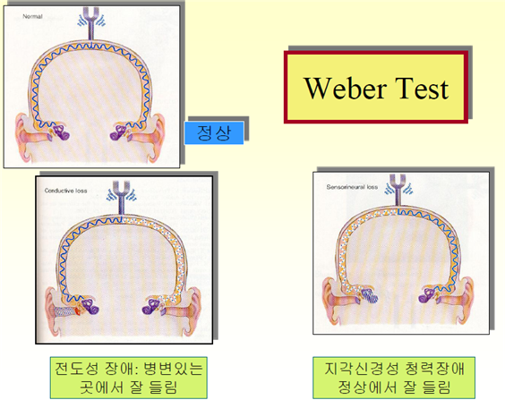 [기본간호]음차를 이용한 청각검사 : Weber test, Rinne test ( 웨버, 린네 검사) : 네이버 블로그