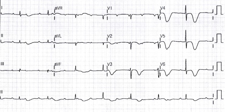 Bradycardia and TdP (서맥과 염전성 심실빈맥) : 네이버 블로그
