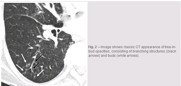 Tree in bud pattern in chest CT : 네이버 블로그