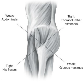 얀다(Janda)의 근육 불균형 패턴 : 하부교차 증후군(Lower Crossed Syndrome) [김형태 트레이너 / 허리 ...