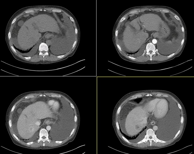 HCC, liver dynamic CT : 네이버 블로그