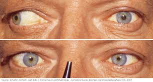 Internuclear ophthalmoplegia (INO) : 네이버 블로그