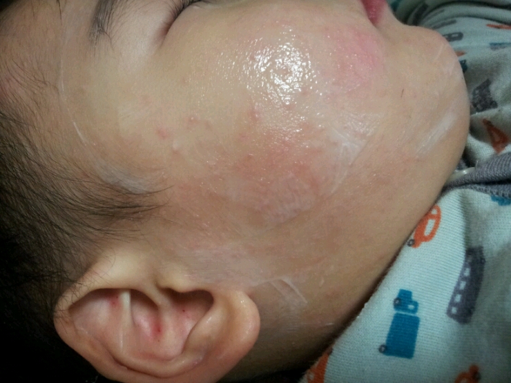 얼굴에 아기 얼굴 태열 좁쌀 같이 올라온 피부 발진 트러블 아토팜 Mle 크림 로션 효과 있을까 아기 얼굴 땀띠