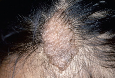 Nevus sebaceus,피지선 모반,피지선 모반 치료,sebaceous nevus,지선모반 : 네이버 블로그