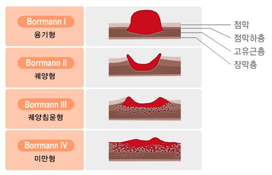 진행성 위암의 분류(Borrmann 보우만 분류법) : 네이버 블로그