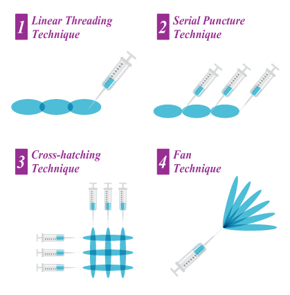 Filler injection method : 네이버 블로그