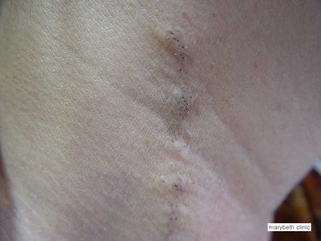 면포성 모반 Nevus comedonicus : 네이버 블로그