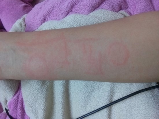 피부묘기증(dermographism) : 네이버 블로그