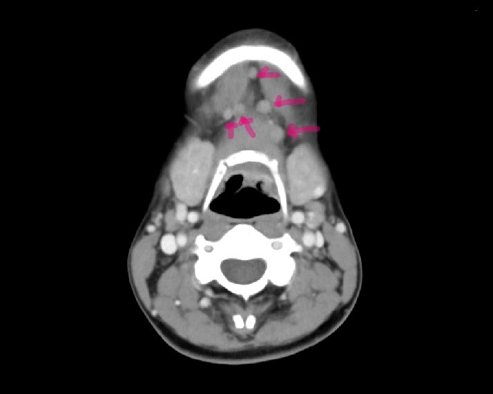 Submental lymphadenopathy : 네이버 블로그