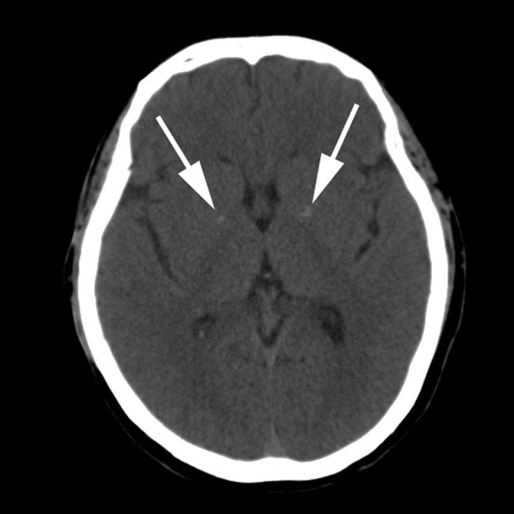 Normal intracranial calcifications(정상적인 두개내(뇌속) 석회화) : 네이버 블로그