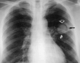 [전공의] Aspergilloma, Monod sign : 네이버 블로그