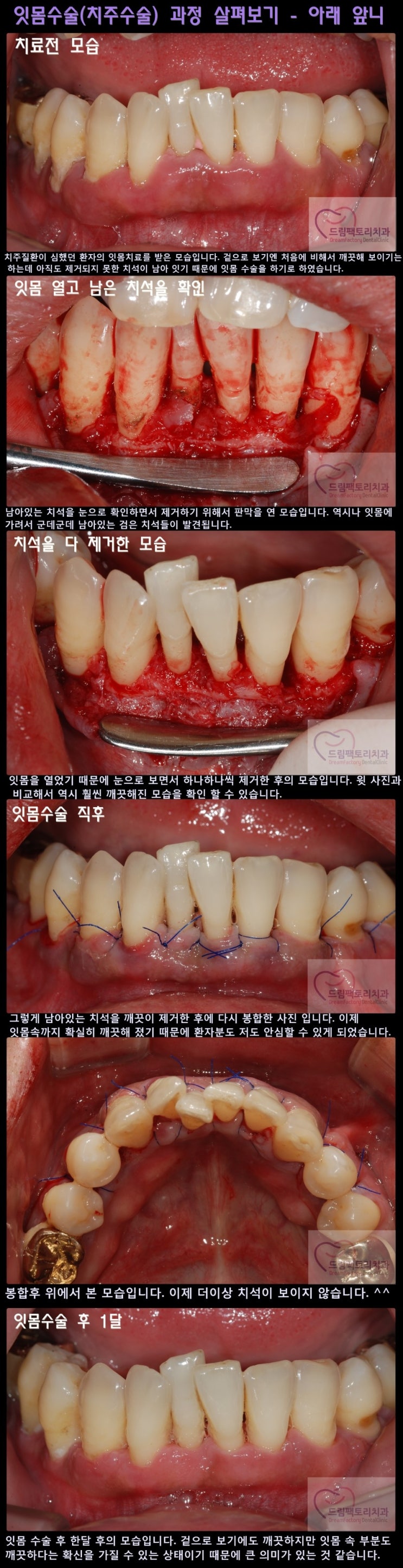 잇몸 치료치주치료 치주수술and잇몸수술치은박리소파술 이란 잇몸질환 치료방법 치주병 치료 Of 드림팩토리치과 네이버 블로그
