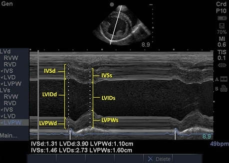 좌심실 구혈률(LVEF) 측정 : 네이버 블로그