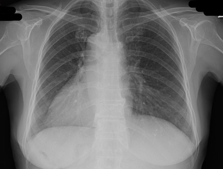 Situs inversus : 네이버 블로그