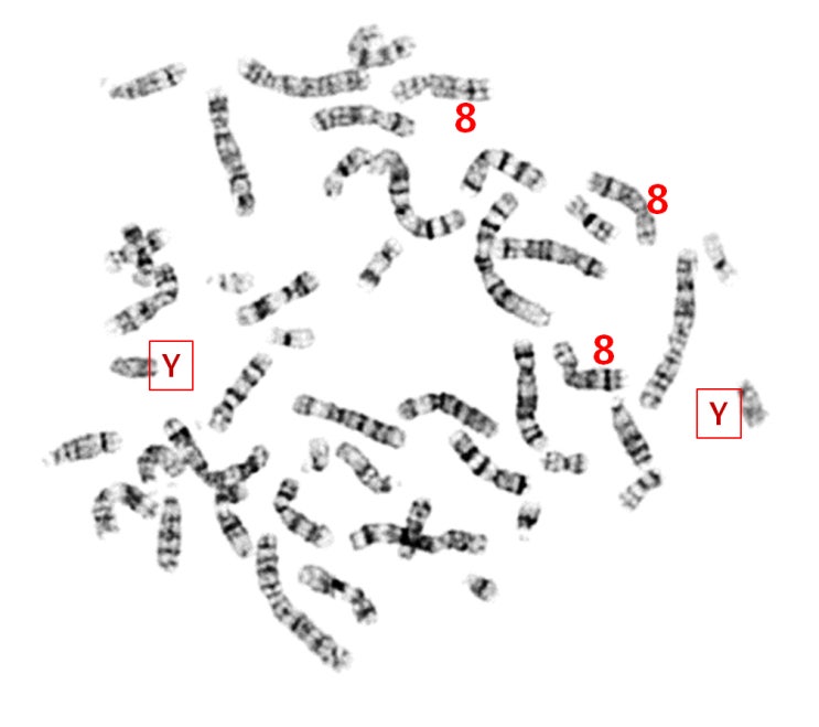 체질성 8삼염색체증후군 섞임증 (trisomy 8 mosaicism) : 네이버 블로그