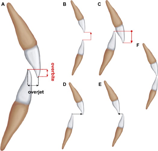 [위아래 앞니와 관계된 용어]open bite, deep bite, cross bite, overjet, overbite ...