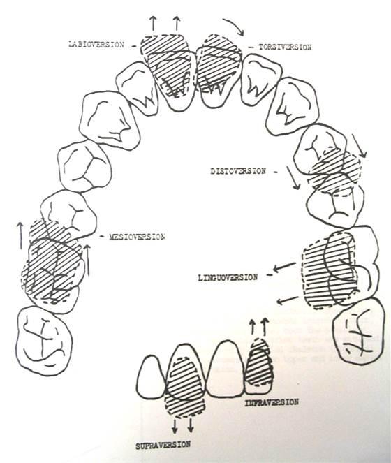 [치아위치이상에 대한 용어]lavioversion, linuoversion, mesioversion, distoversion 등 ...
