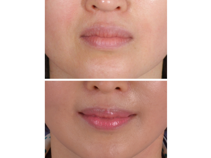 입꼬리올림 후 4년 지난 모습은 어떨까!(What will be the result after the smile lipt ...