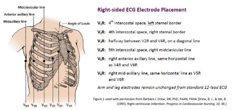 Right sided and Posterior ECG : 네이버 블로그