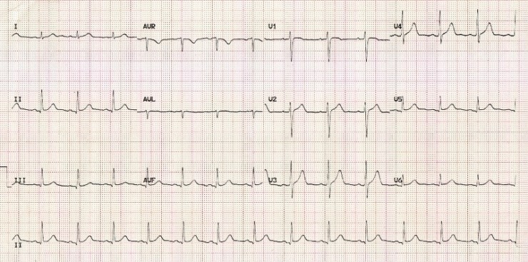 NSR (Normal sinus rhythm)★ (1) : 네이버 블로그