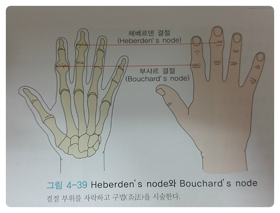 [재활의학] Heberden's node와 Bouchard's node : 네이버 블로그